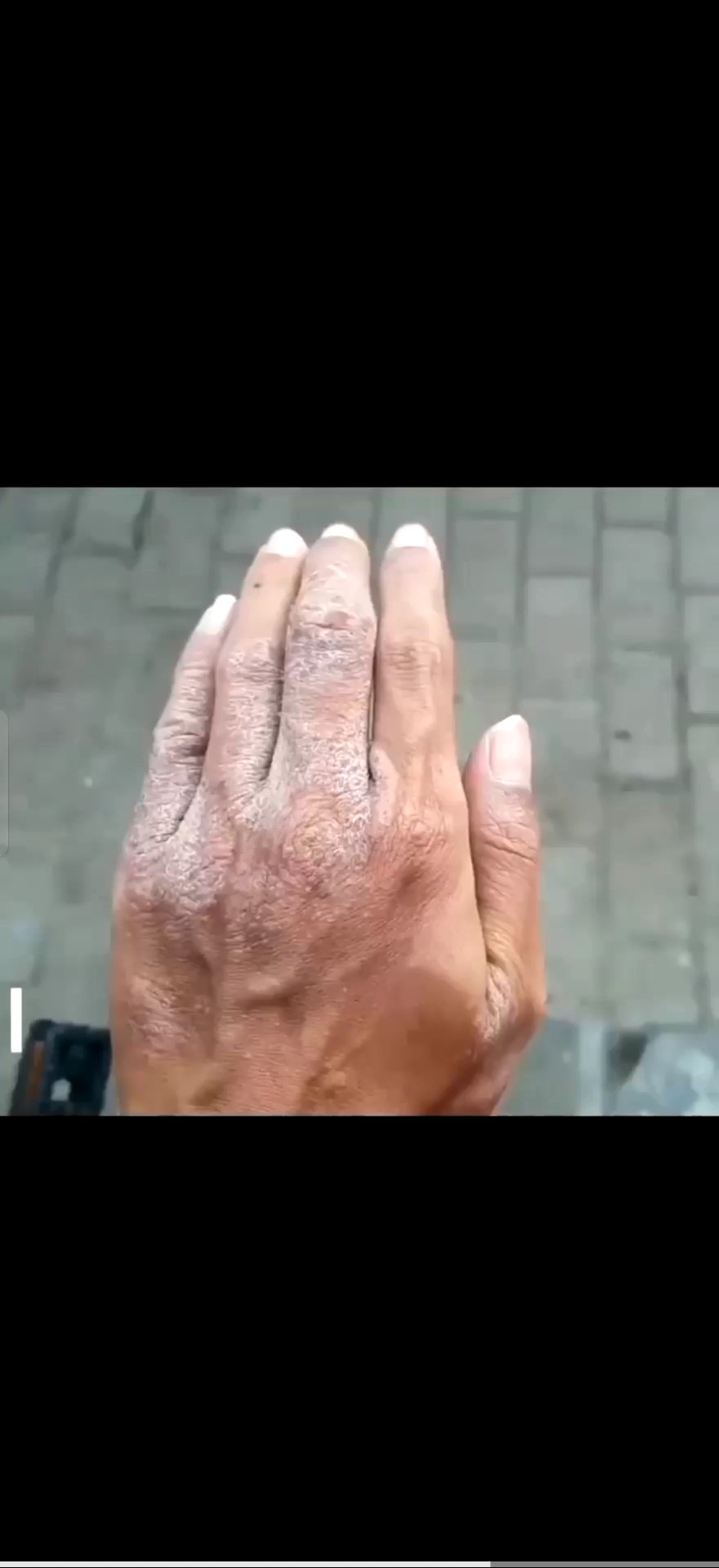 SALEP PSORIASIS salep eksim jamur dermatitis racikan dokter spesialis ...